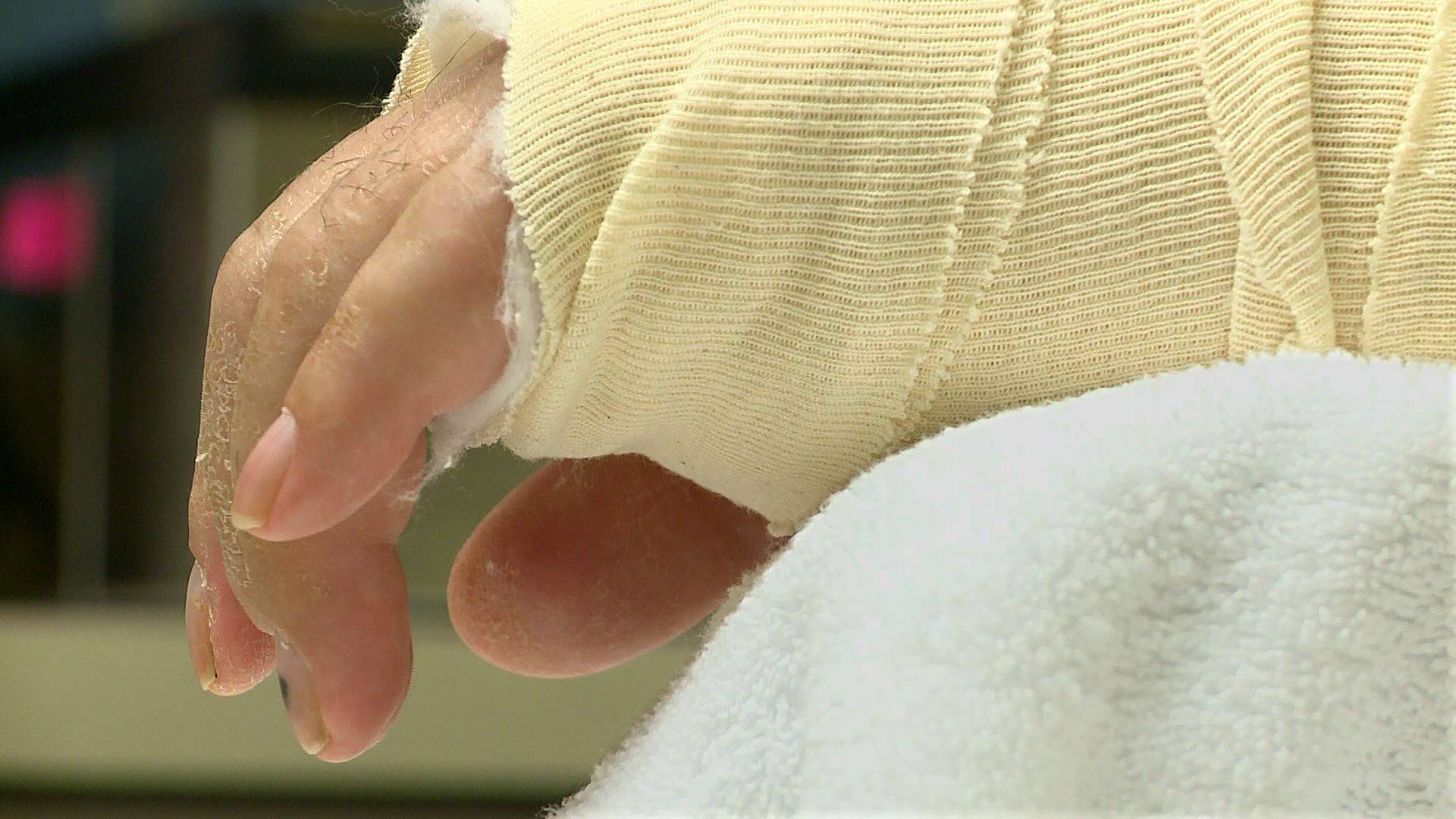 Firefighters, surgeons save man's severed hand | 11alive.com