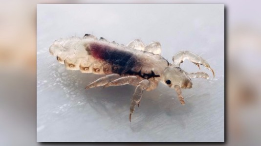 'Super lice' crawl into 48 states; you can stop 'em dead | 11alive.com