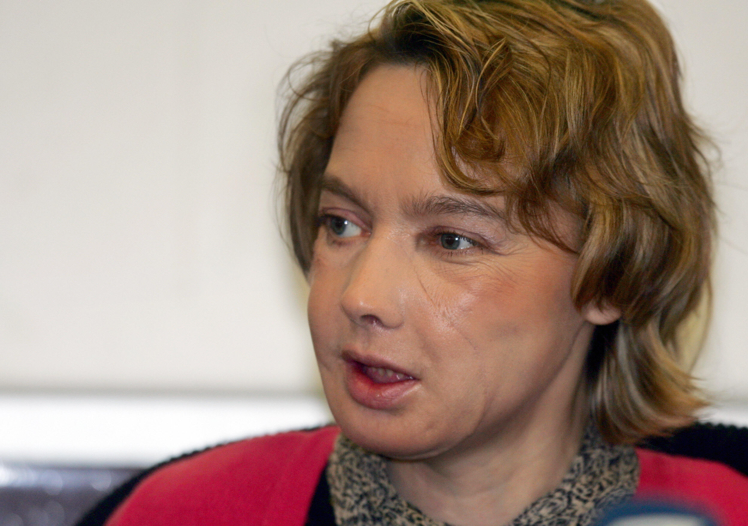 World's 1st Face Transplant Recipient Dies at 49 | wltx.com